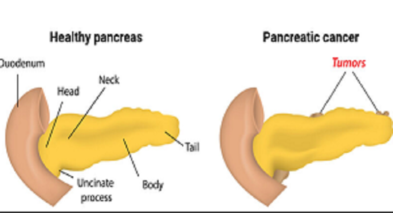 A relief to pancreatic cancer patients… researchers have come with ...